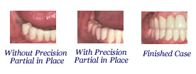 Precision Attachment Partial Dentures - Edward Feinberg, DMD Edward M ...