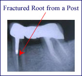 Root Canal Therapy - Edward Feinberg, DMD Edward M. Feinberg, D.M.D.