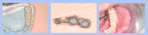 Dental Restoration - Edward Feinberg, DMD - Scarsdale Edward M ...