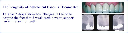 Precision Attachment Partial Dentures - Edward Feinberg, DMD Edward M ...