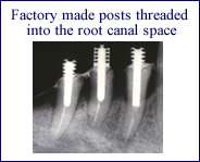 Root Canal Therapy - Edward Feinberg, DMD